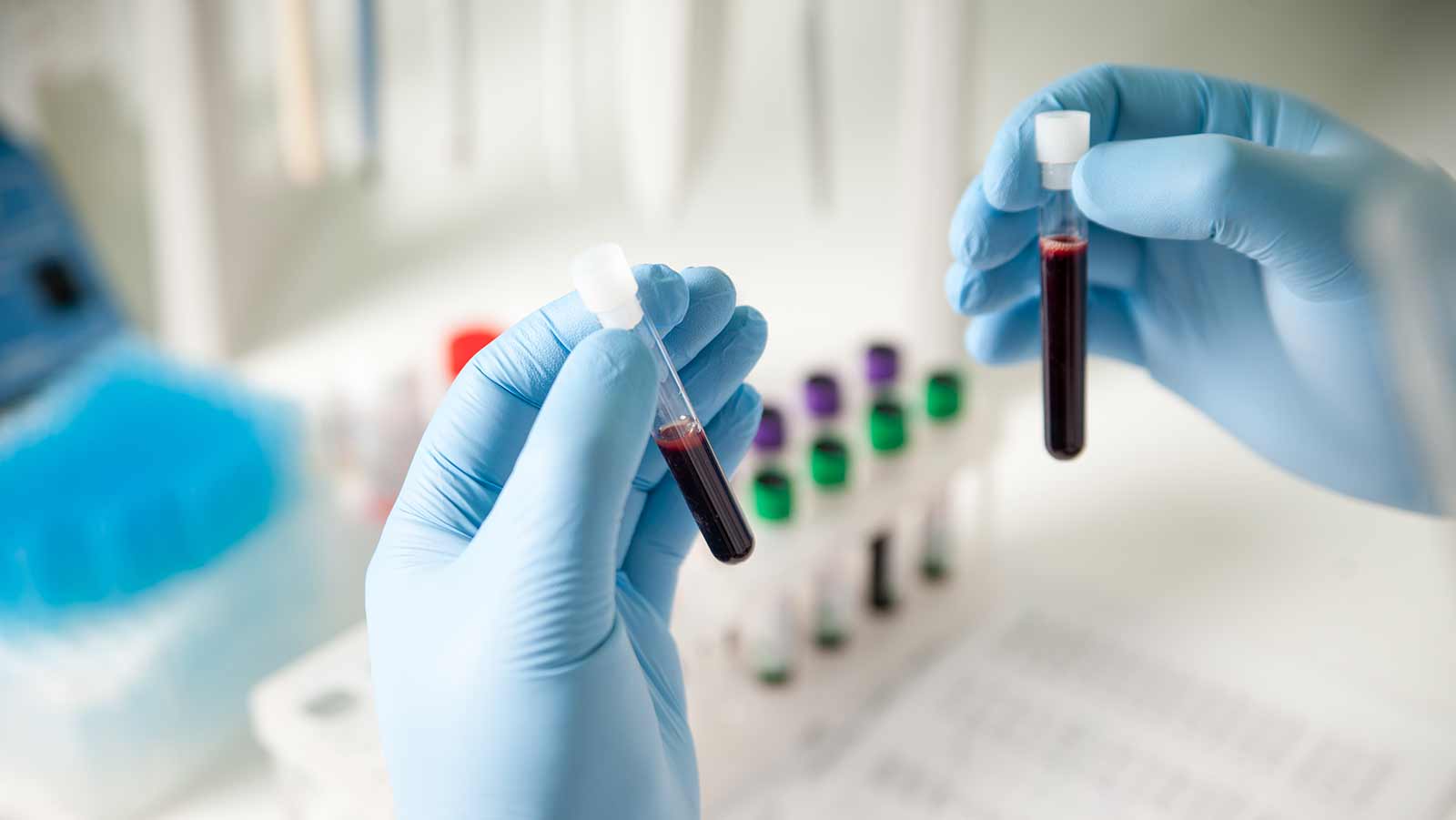 Laboratorij - Kompletna krvna slika - Poliklinika Lokrum